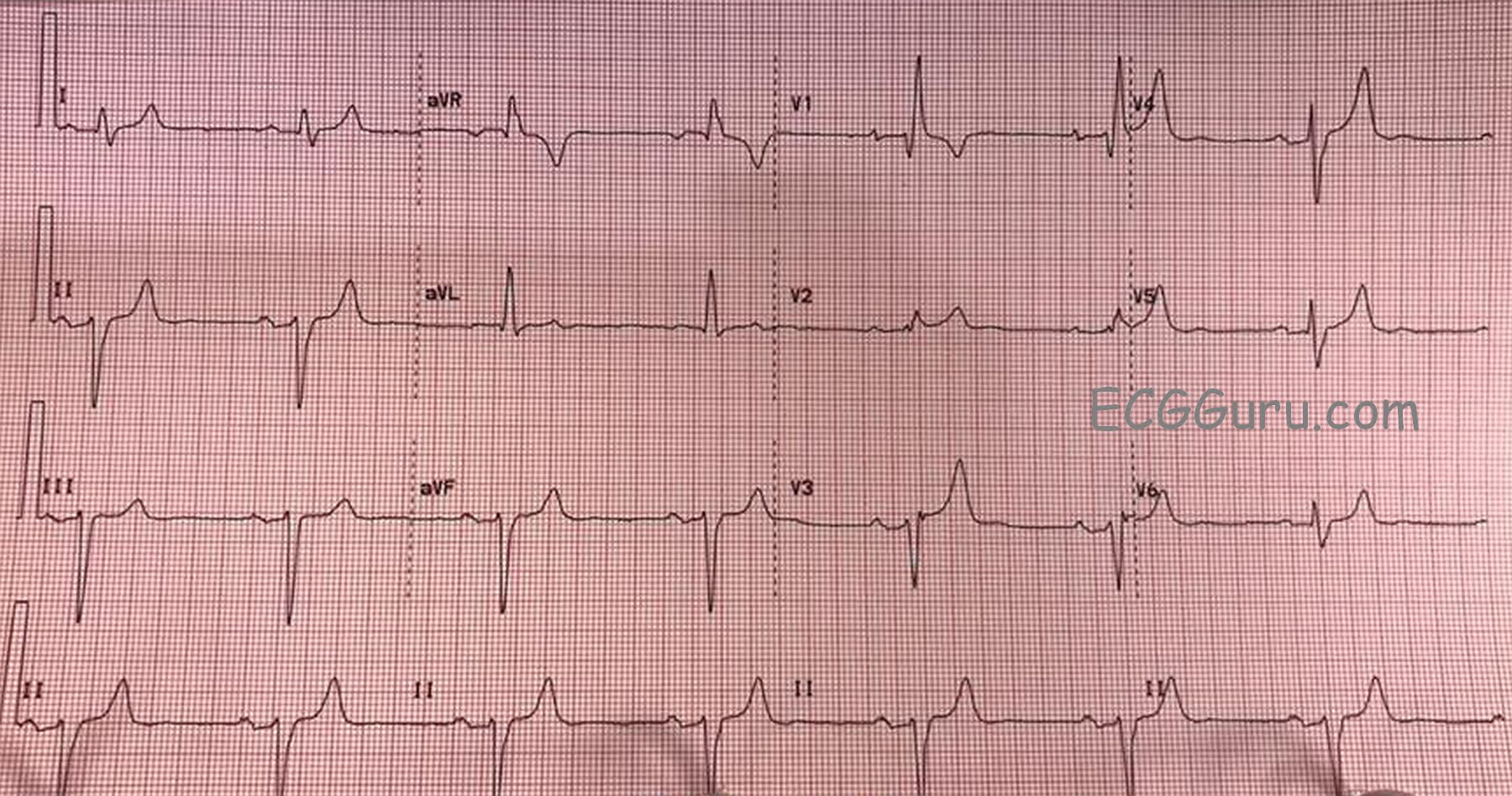 Bifascicular Block And Sinus Bradycardia Ecg Guru Instructor Resources